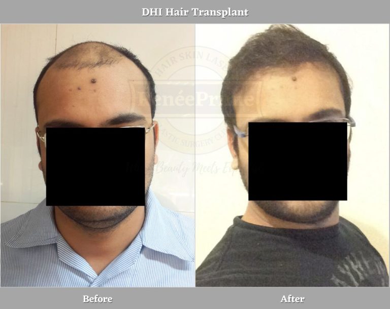 DHI Hair Transplant - RenéePrime Clinic