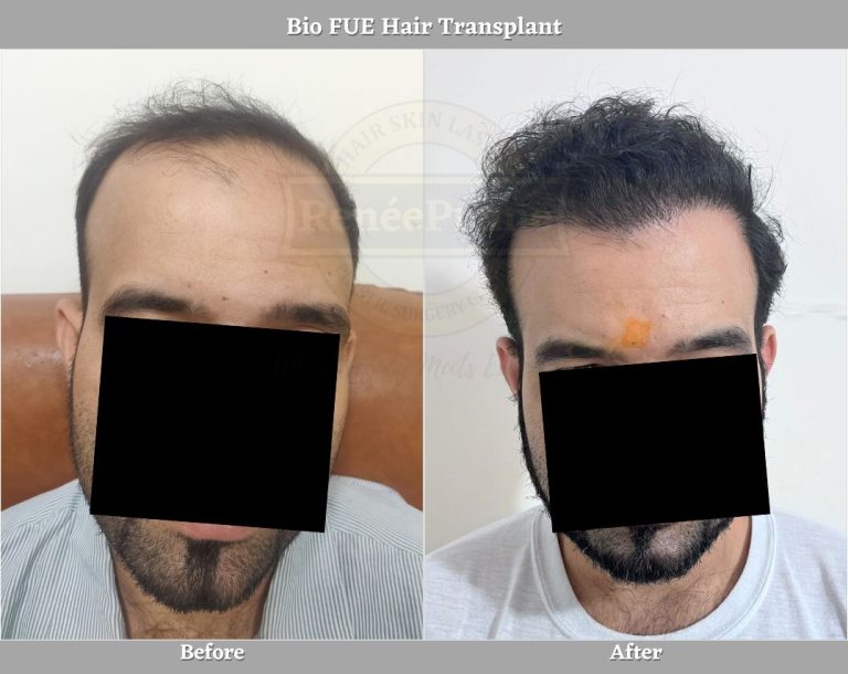 Bio FUE Hair Transplant - RenéePrime Clinic