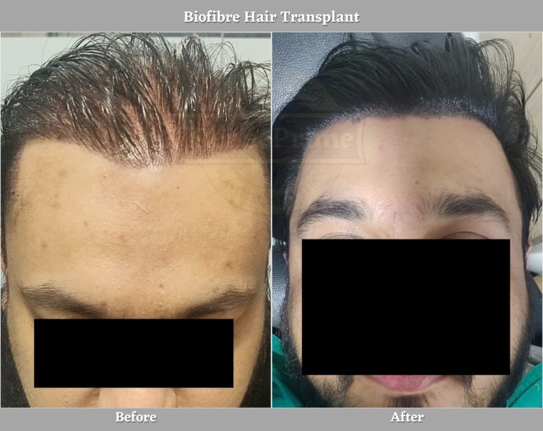 Biofibre Hair Transplant in Mumbai | RenéePrime Clinic