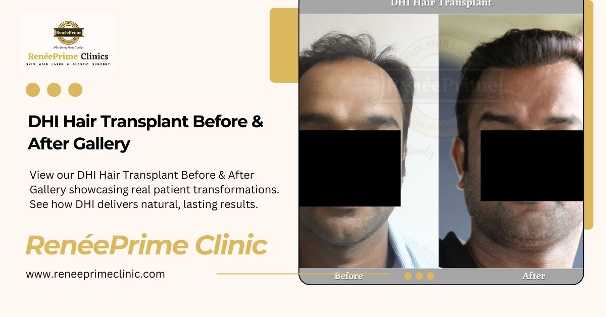 DHI Hair Transplant Before & After Gallery