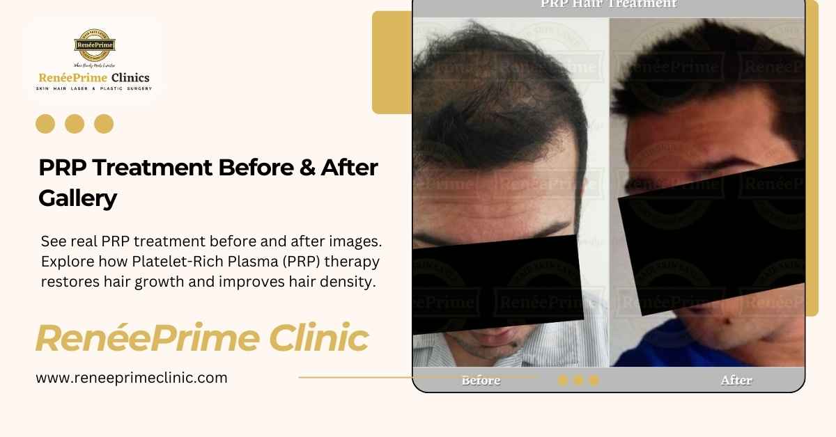 PRP Treatment Before and After Images