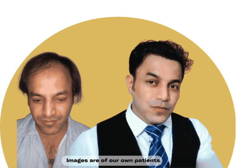 Hair Transplant in Mumbai | RenéePrime Clinic