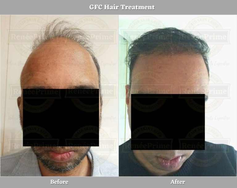Growth Factor Therapy Before & After Gallery