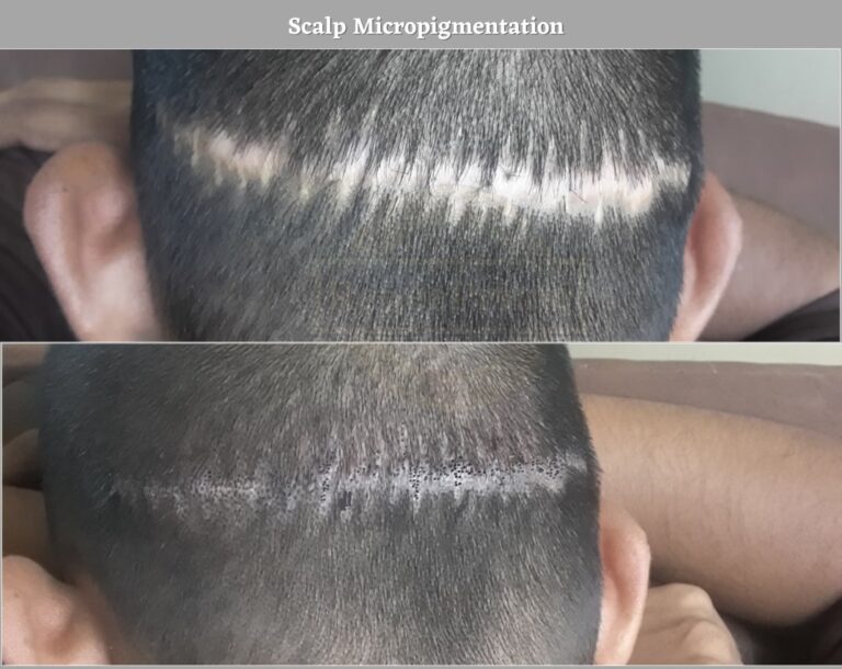 Scalp Micropigmentation Before & After Gallery | SMP Results