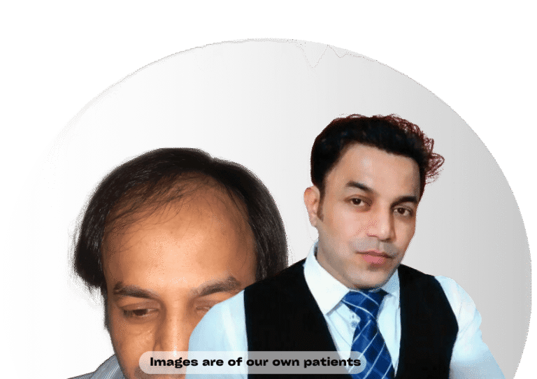Hair Transplant in Mumbai | RenéePrime Clinic